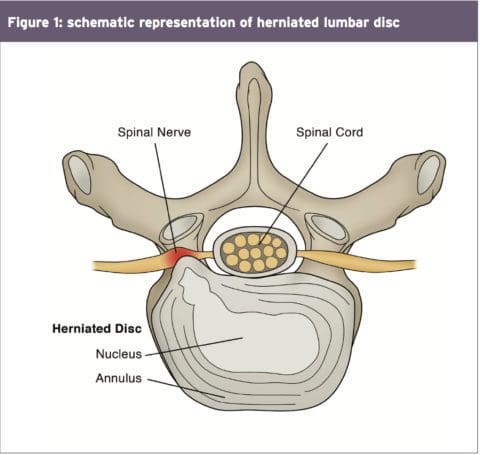 Lumbar Disc Herniation & Micro-Disectomy Surgery - El Paso Back Clinic ...
