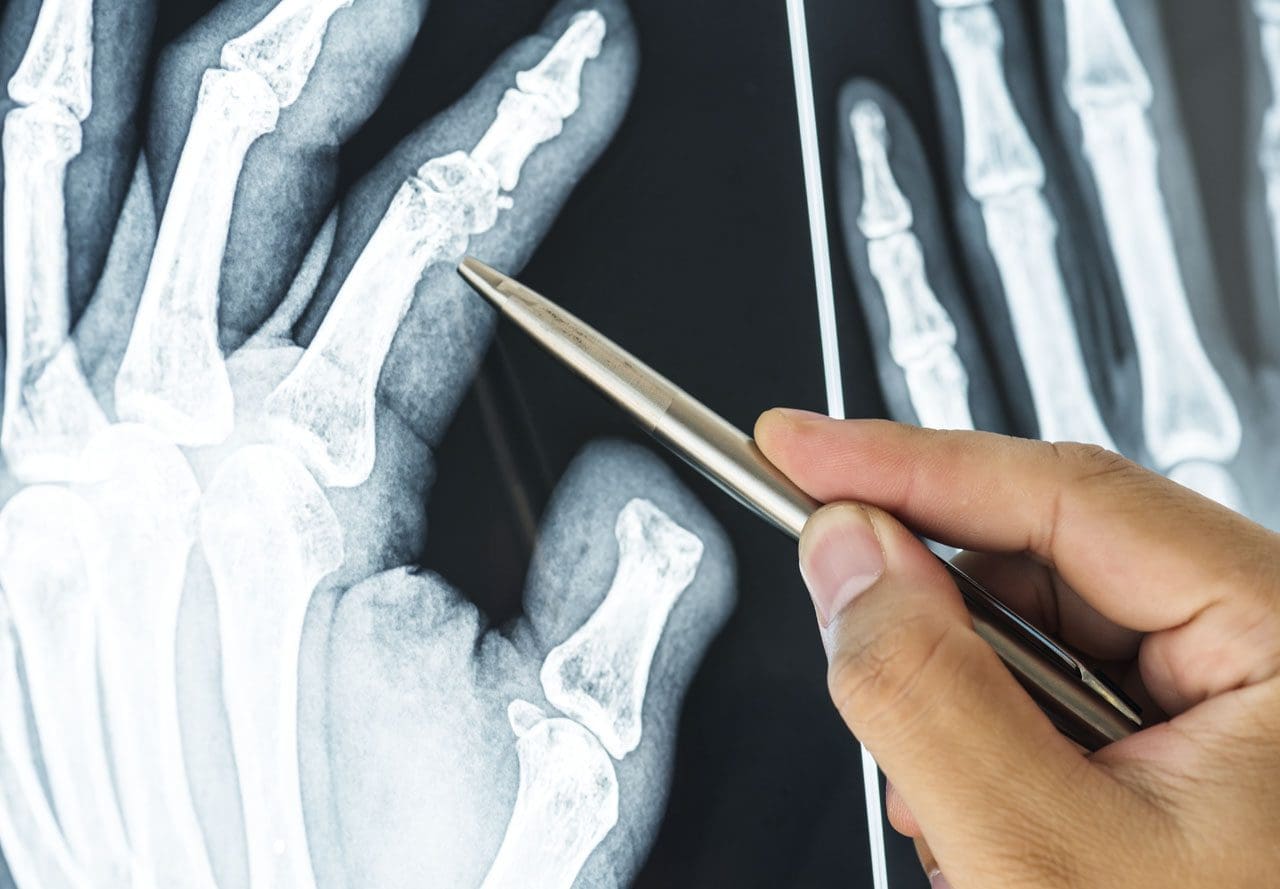 How to Identify and Treat Finger Sprains and Dislocations - El Paso ...